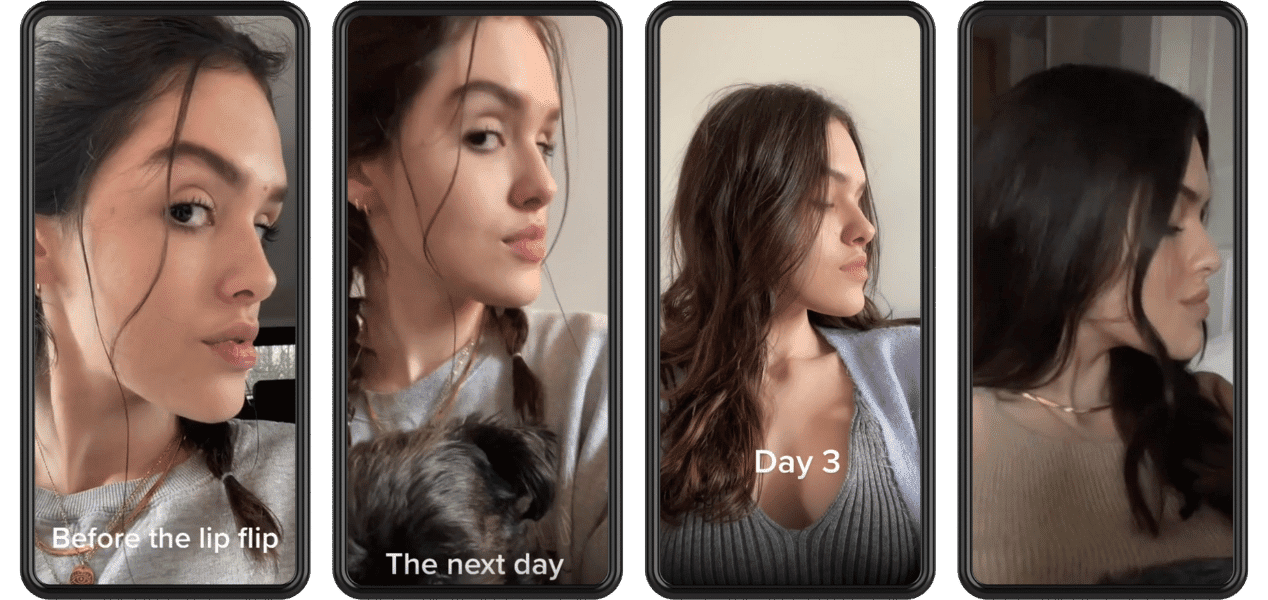 Lip Flip Before And After Pictures And Videos Drug Genius