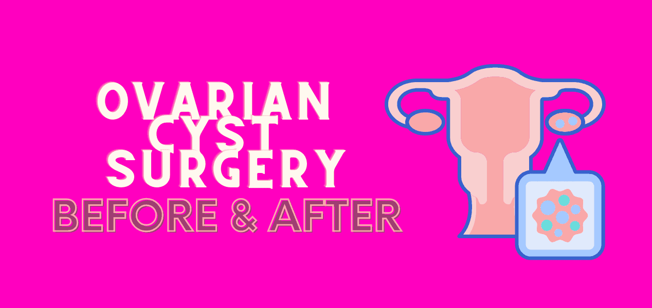 Before And After Ovarian Cyst Surgery Photos Drug Genius